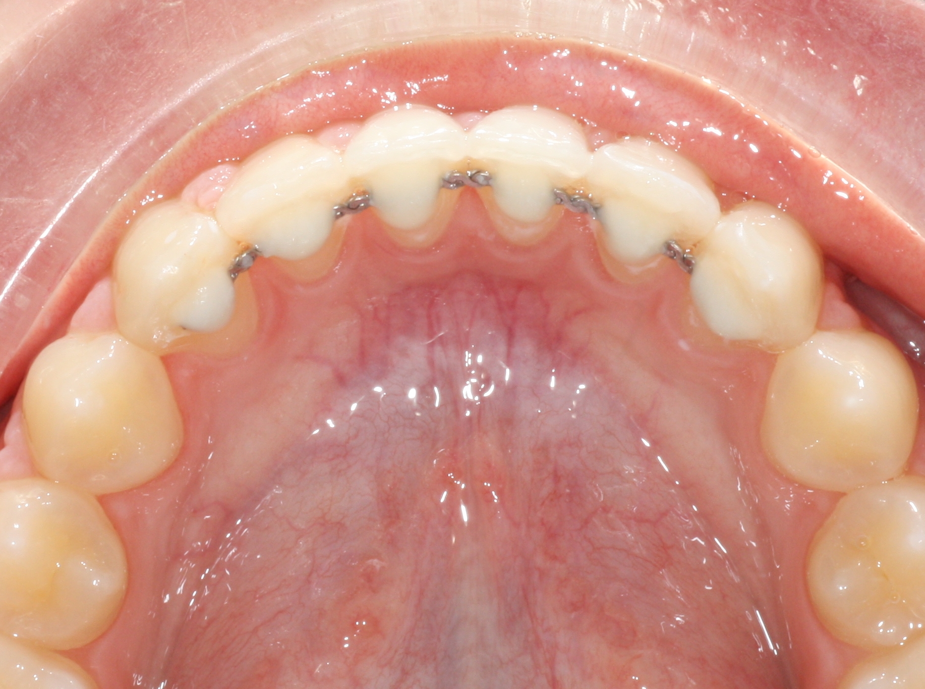 Dermot Kavanagh Orthodontist Dublin | Latest News | What Are Retainers ...